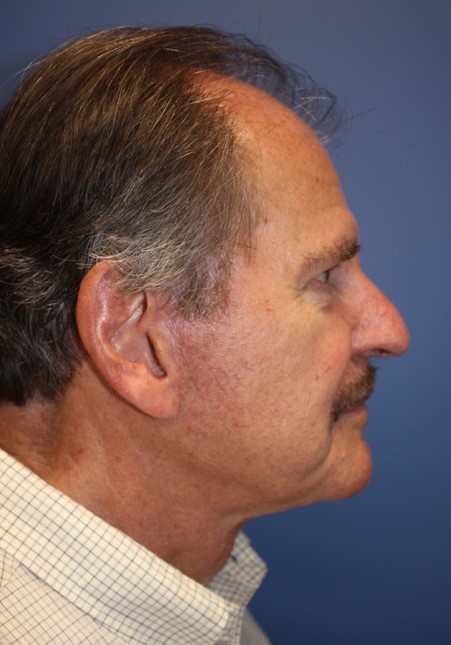 Face Procedures - Surek Plastic Surgery